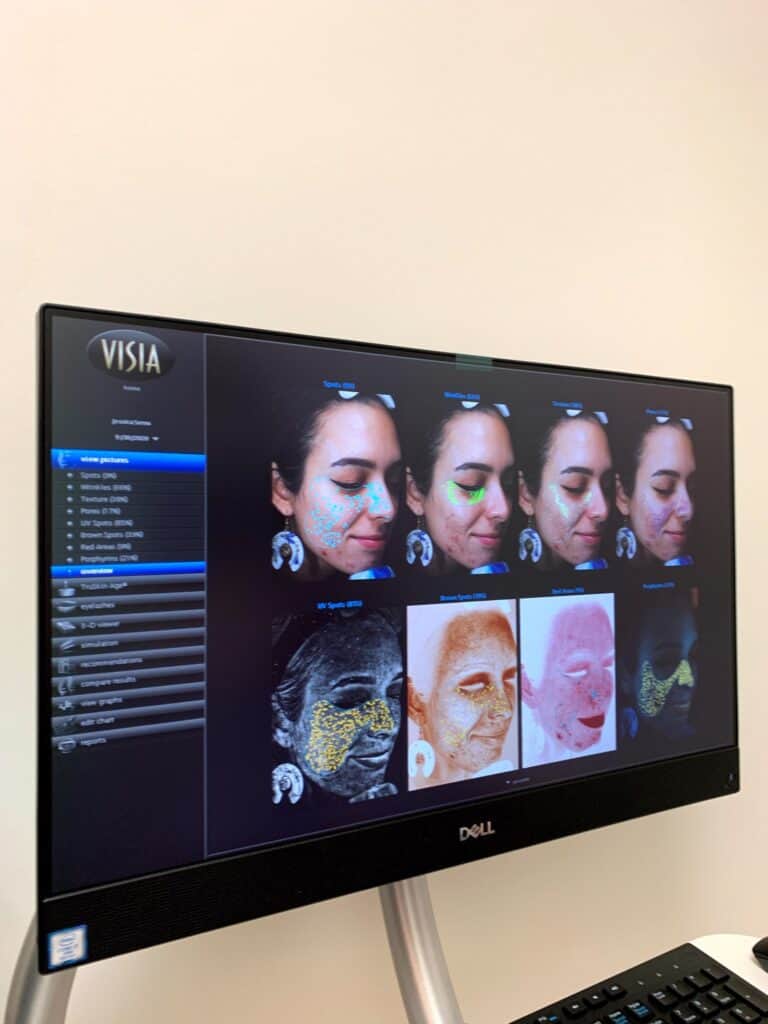 Le Beauty Med Spa Dallas Acne Skin Transformation - My Curly Adventures