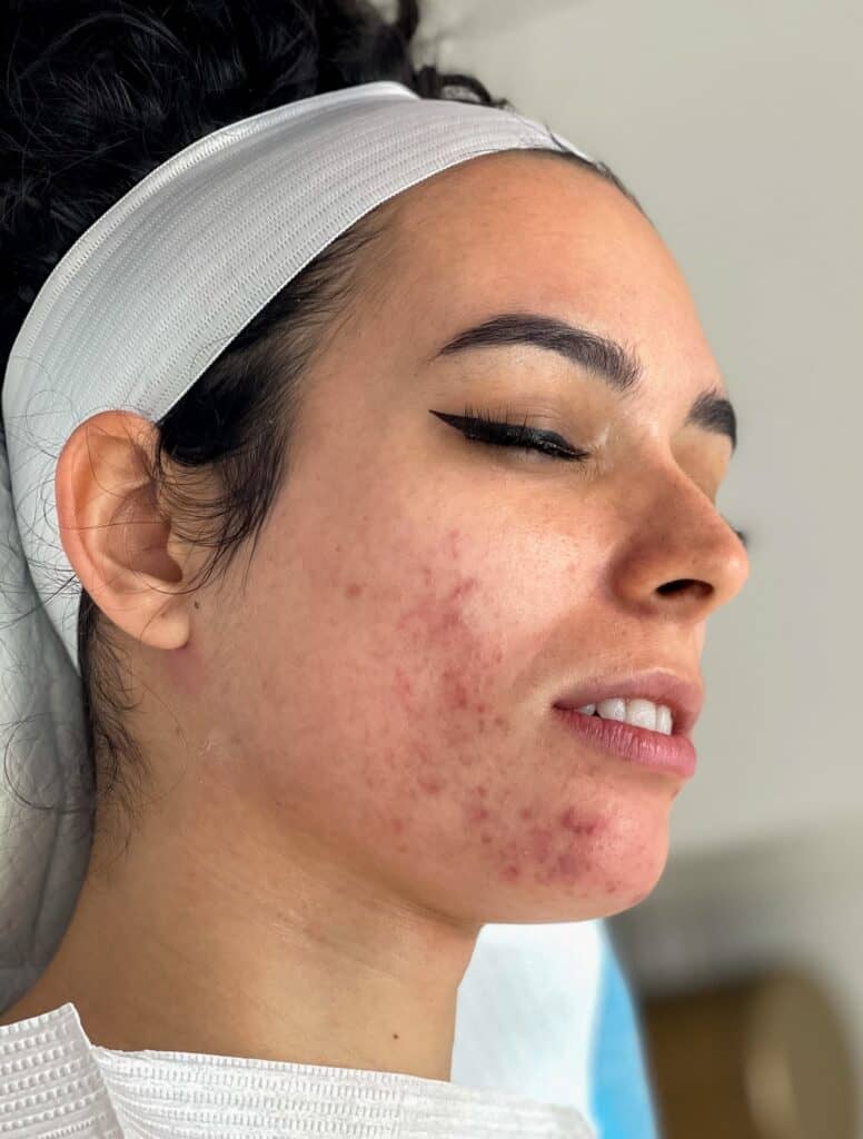 Le Beauty Med Spa Dallas Acne Skin Transformation - My Curly Adventures